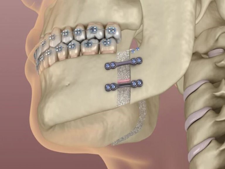Ortognatodonzia Milano Chirurgia correttiva di mascella e denti!